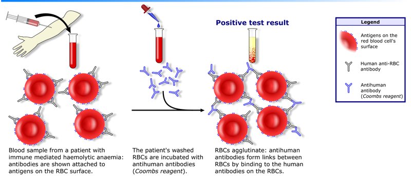 Important ICU teaching case: A woman with AL amyloidosis presents with ...