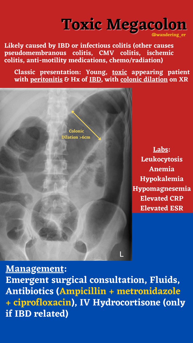 Toxic Megacolon X Ray