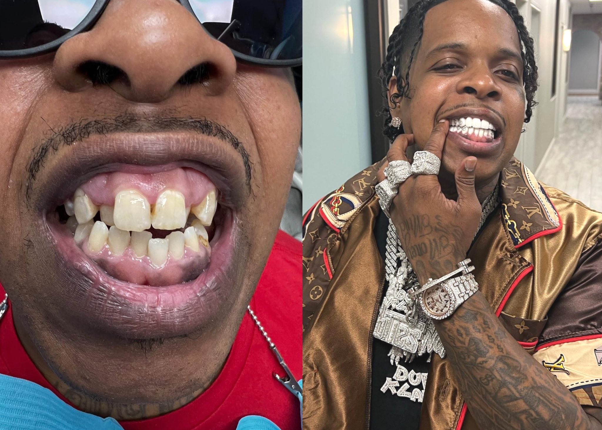 DomisLive NEWS on Twitter: "Finesse2Tymes shows off a before and after of getting his teeth done ...
