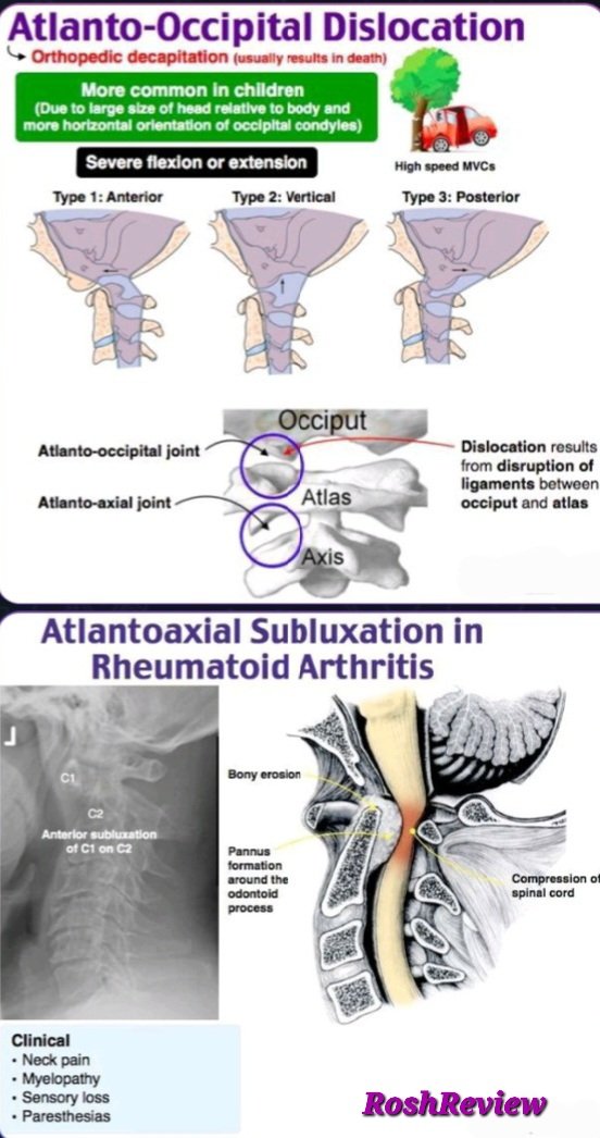 Atlantoaxial Joint Movement