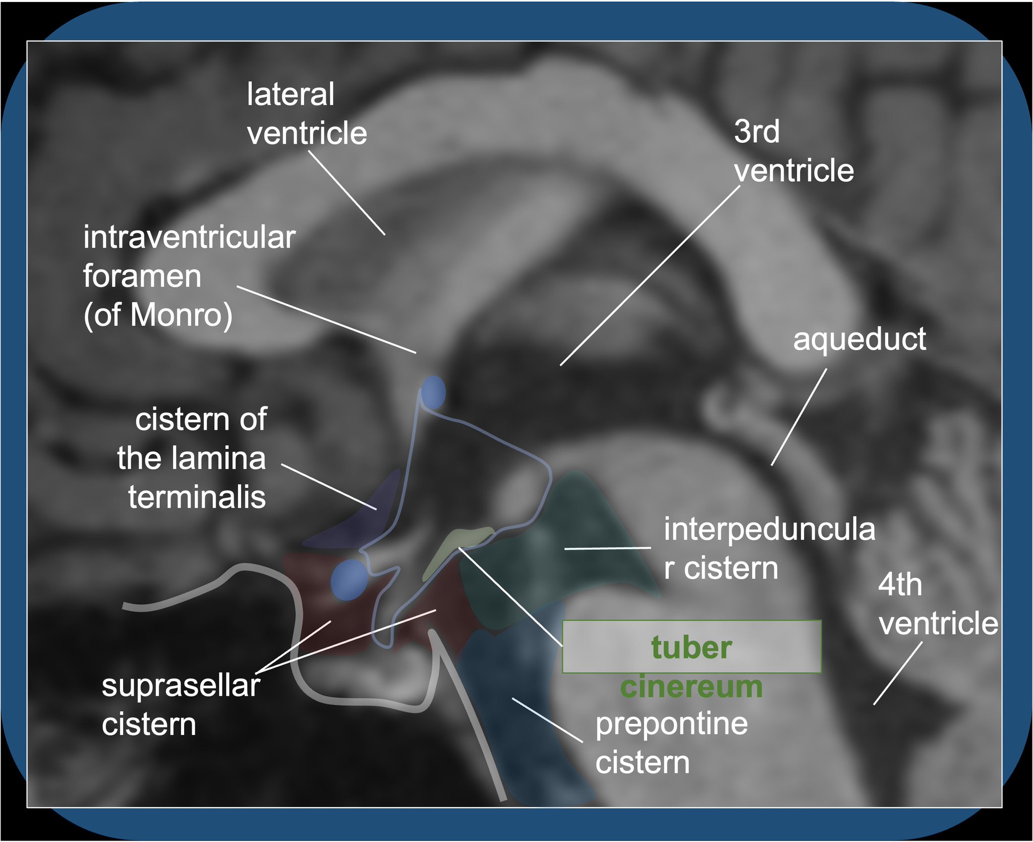 Lamina Terminalis Cistern