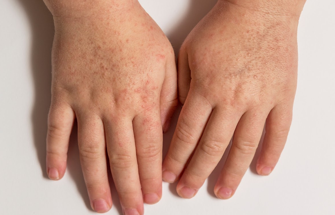 Strep Rash Scarlet Fever