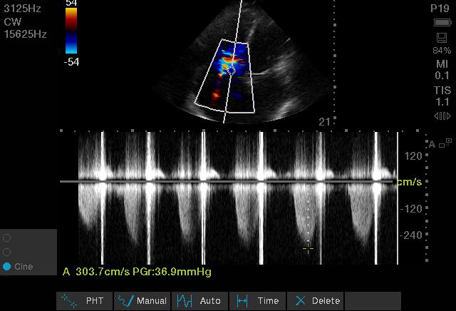 #POCUS case - calling all #DiuresisJedis and RV enthusiasts. This was a ...