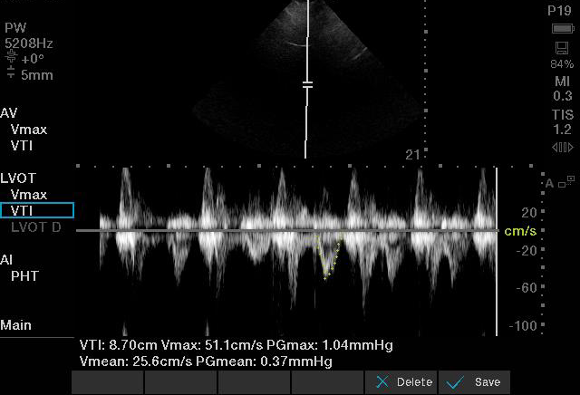 #POCUS case - calling all #DiuresisJedis and RV enthusiasts. This was a ...