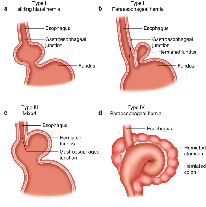 Cigis Hospital Types Of Hiatal Hernia Also Known As Hiatus 50 Off