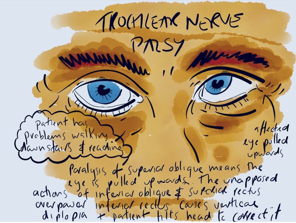 Trochlear Nerve Palsy
