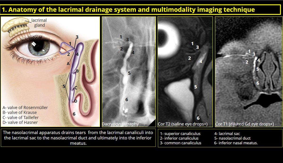 Inferior Meatus Nasolacrimal Duct Surgical Anatomy Of The Nasal Cavity