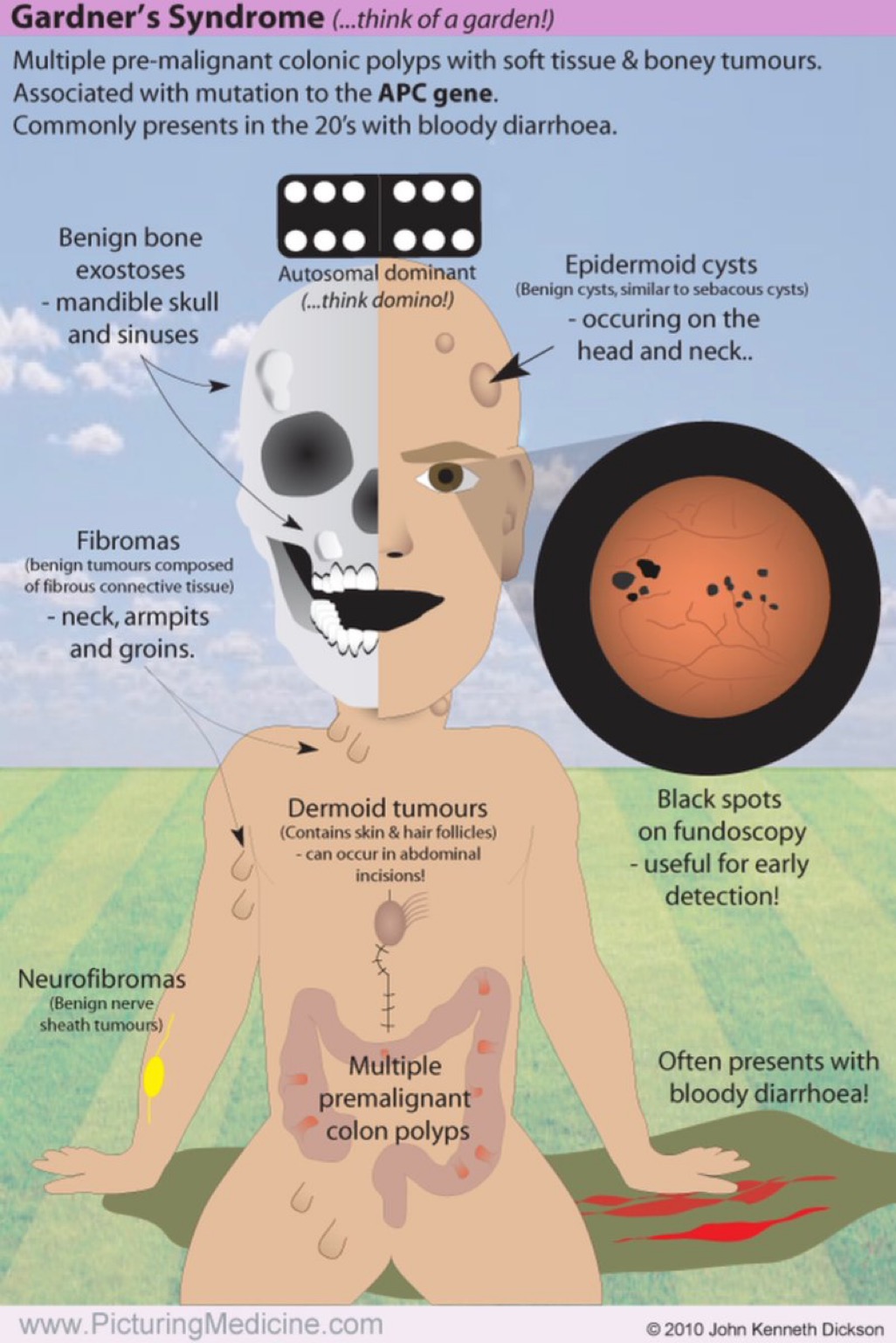 Gardners Syndrome