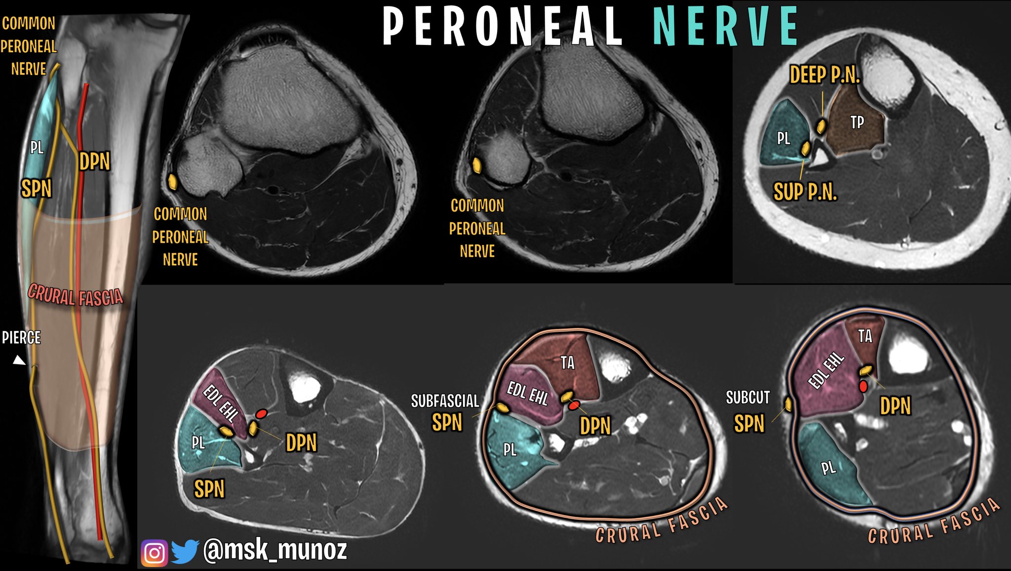 Anterior Calf Muscles Axial