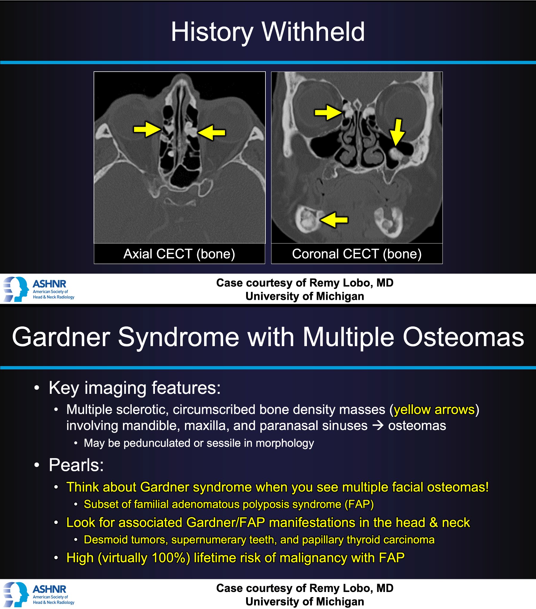 Gardner Syndrome