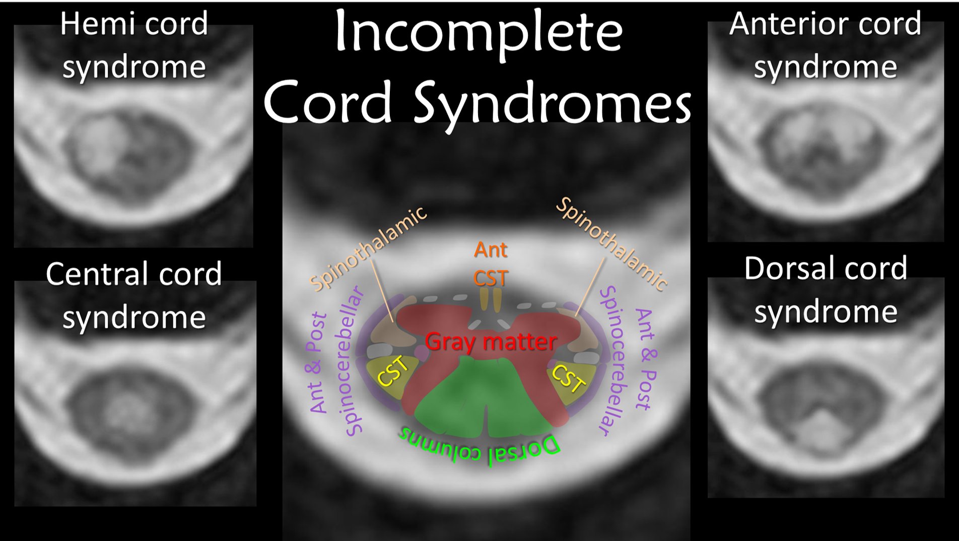 Anterior Cord Syndrome Mri