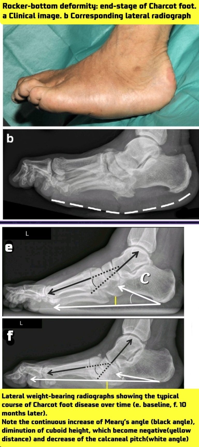 Charcot Foot Pictures Charcot Joints