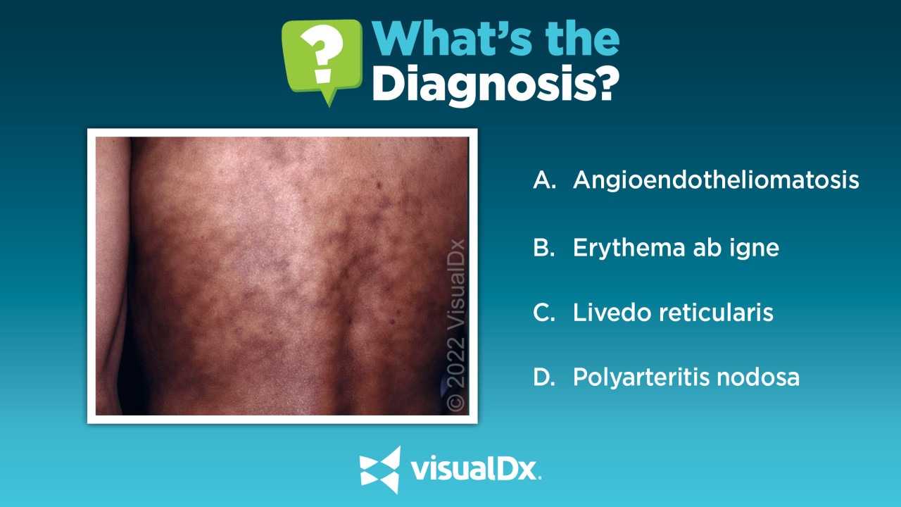 VisualDx on Twitter: "What's the Dx? 38 yo woman w/truncal discoloration that developed 2 mos ...