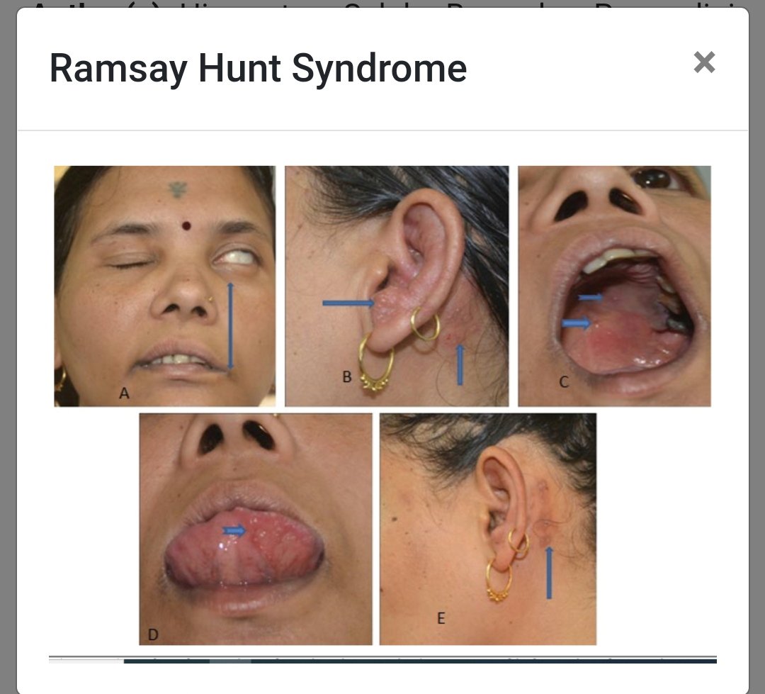 Ramsay Hunt Syndrome Tongue