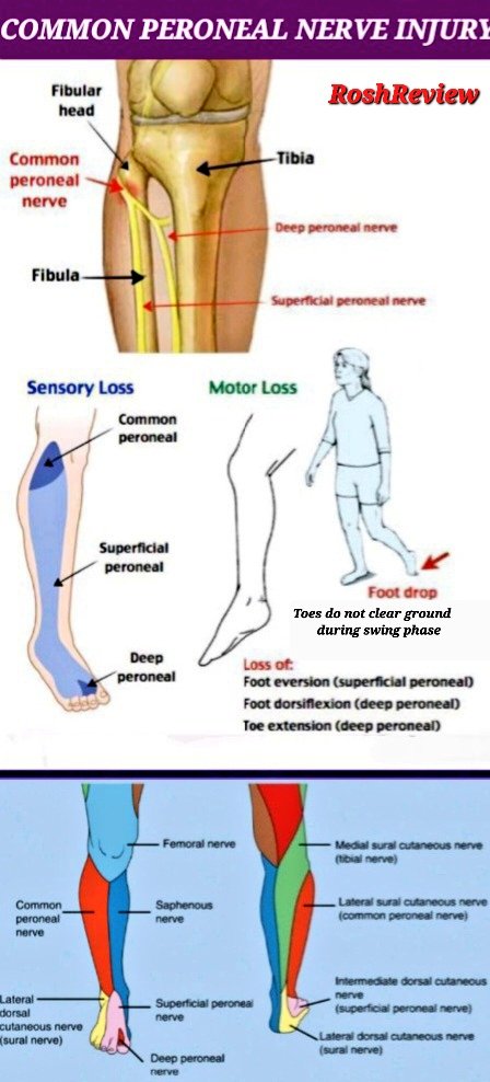 Common Peroneal Nerve