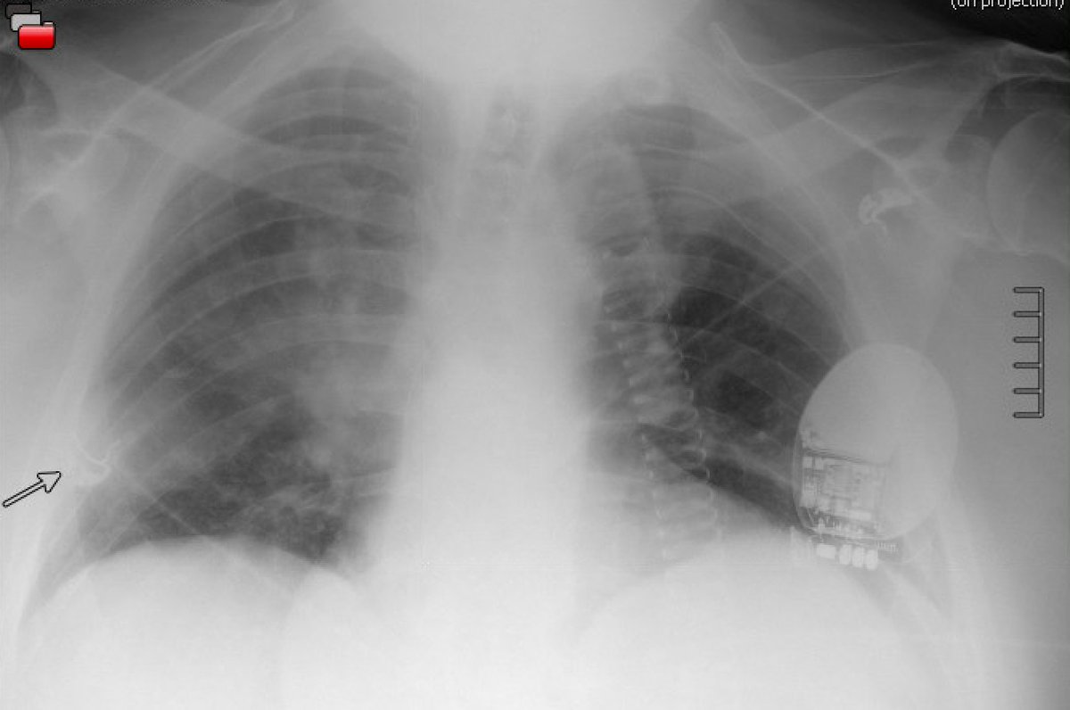 💀 Pulmonary Infarction 💀 Is that focal chest consolidation a pneumonia ...