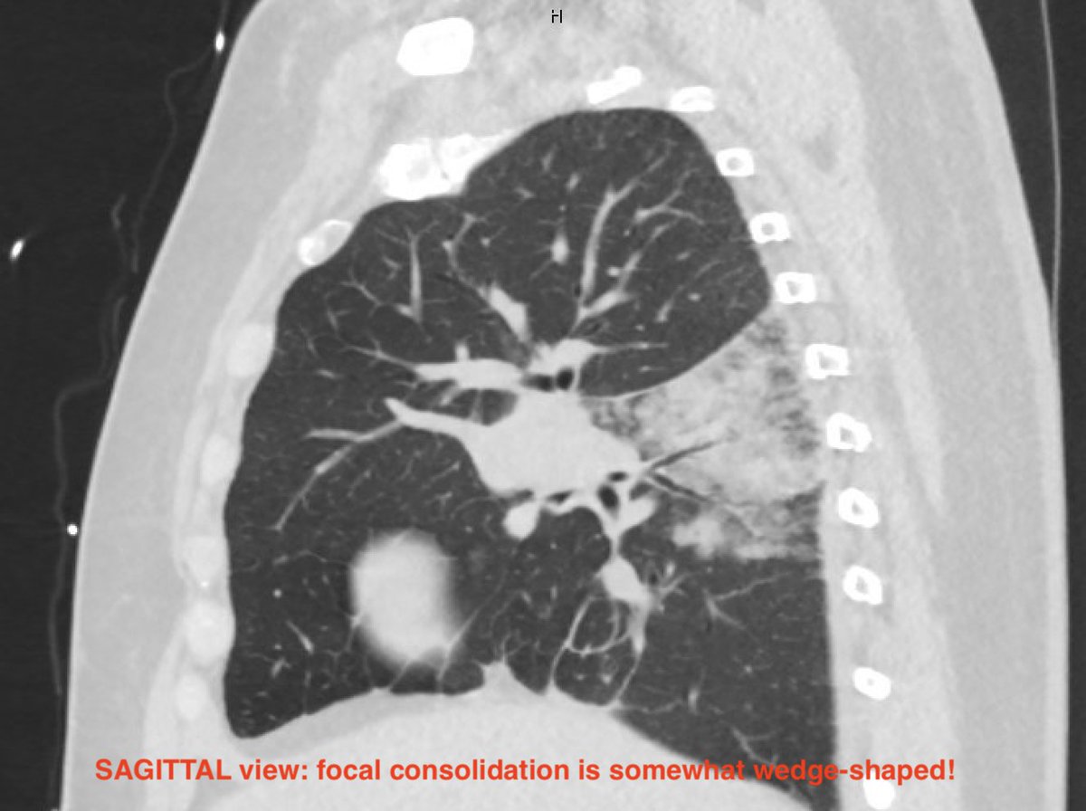 💀 Pulmonary Infarction 💀 Is that focal chest consolidation a pneumonia ...