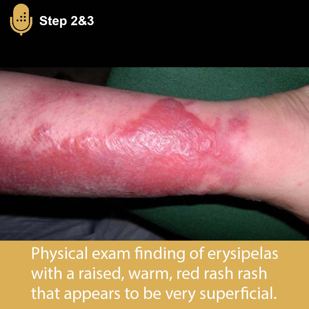 Erysipelas Vs Cellulitis