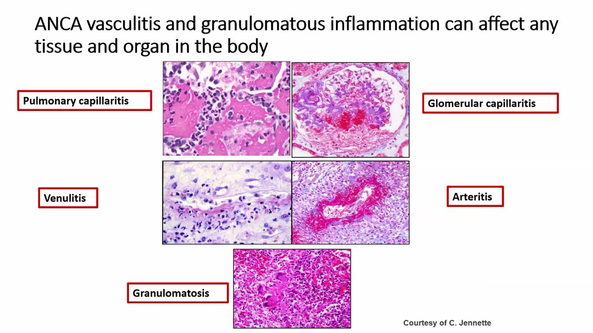 What Is Anca Vasculitis Disease – PSFLM