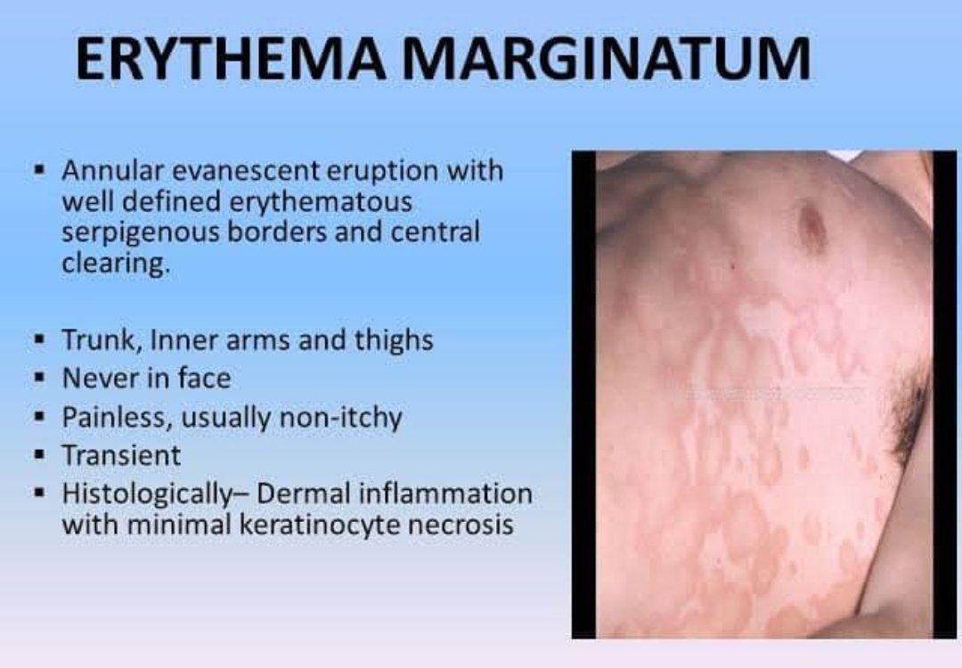 Erythema Marginatum Rheumatic Fever