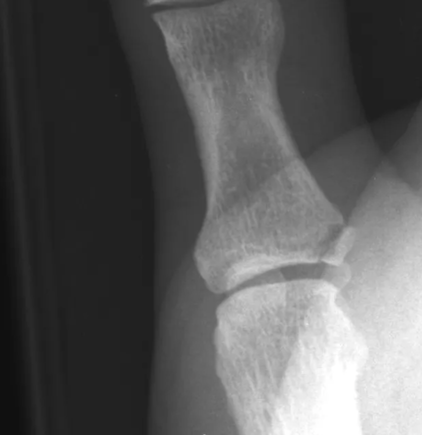 Radrounds Radiology Network On Twitter No Fracture Or Fracture What