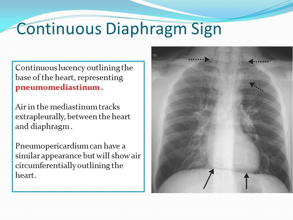 Continuous Diaphragm Sign