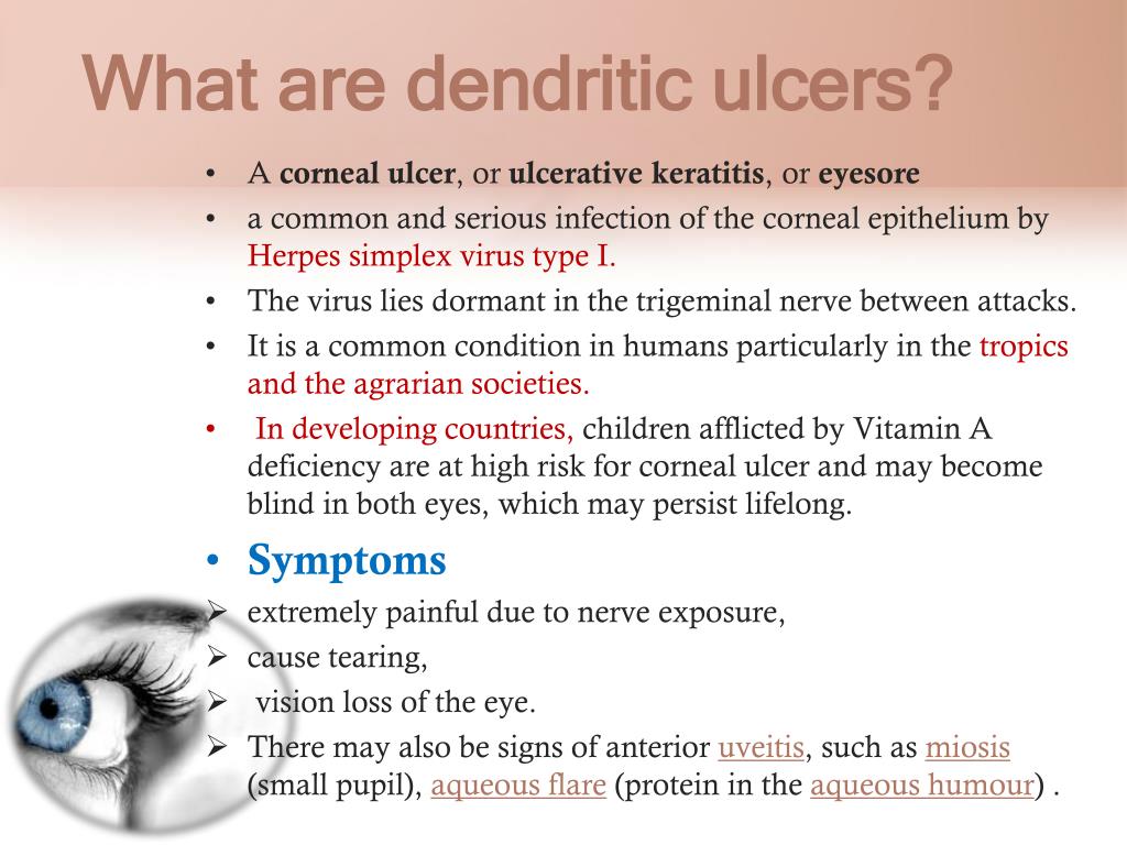 Dendritic Corneal Ulcer