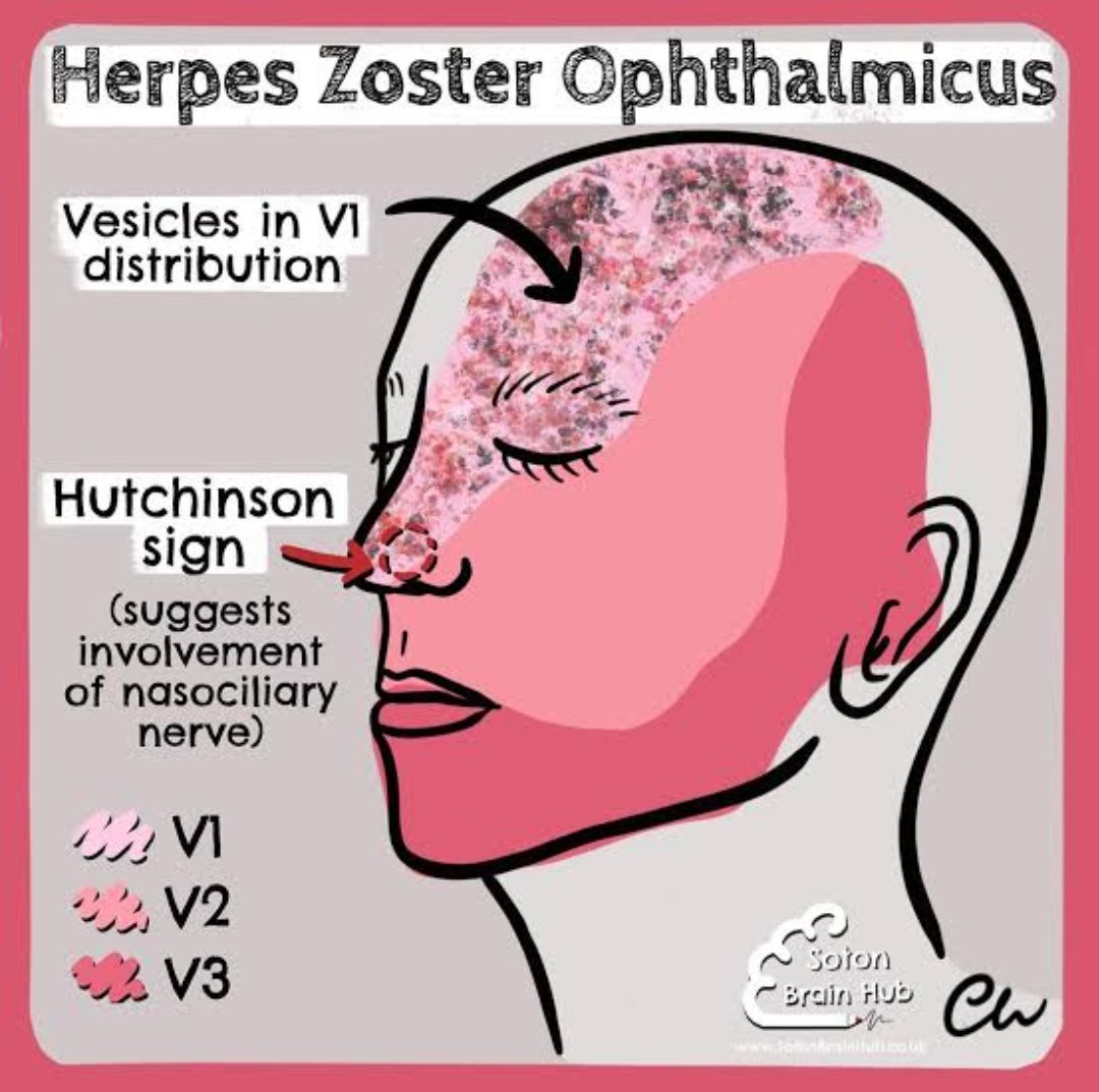 Herpes Zoster Ophthalmicus Hutchinson Sign