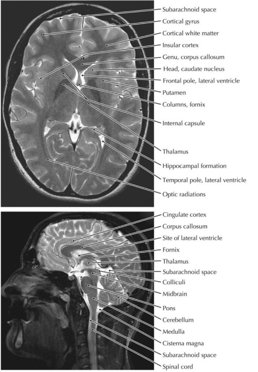 Normal Brain Mri Labeled Magnetic Resonance Images Of The Brain (MRI