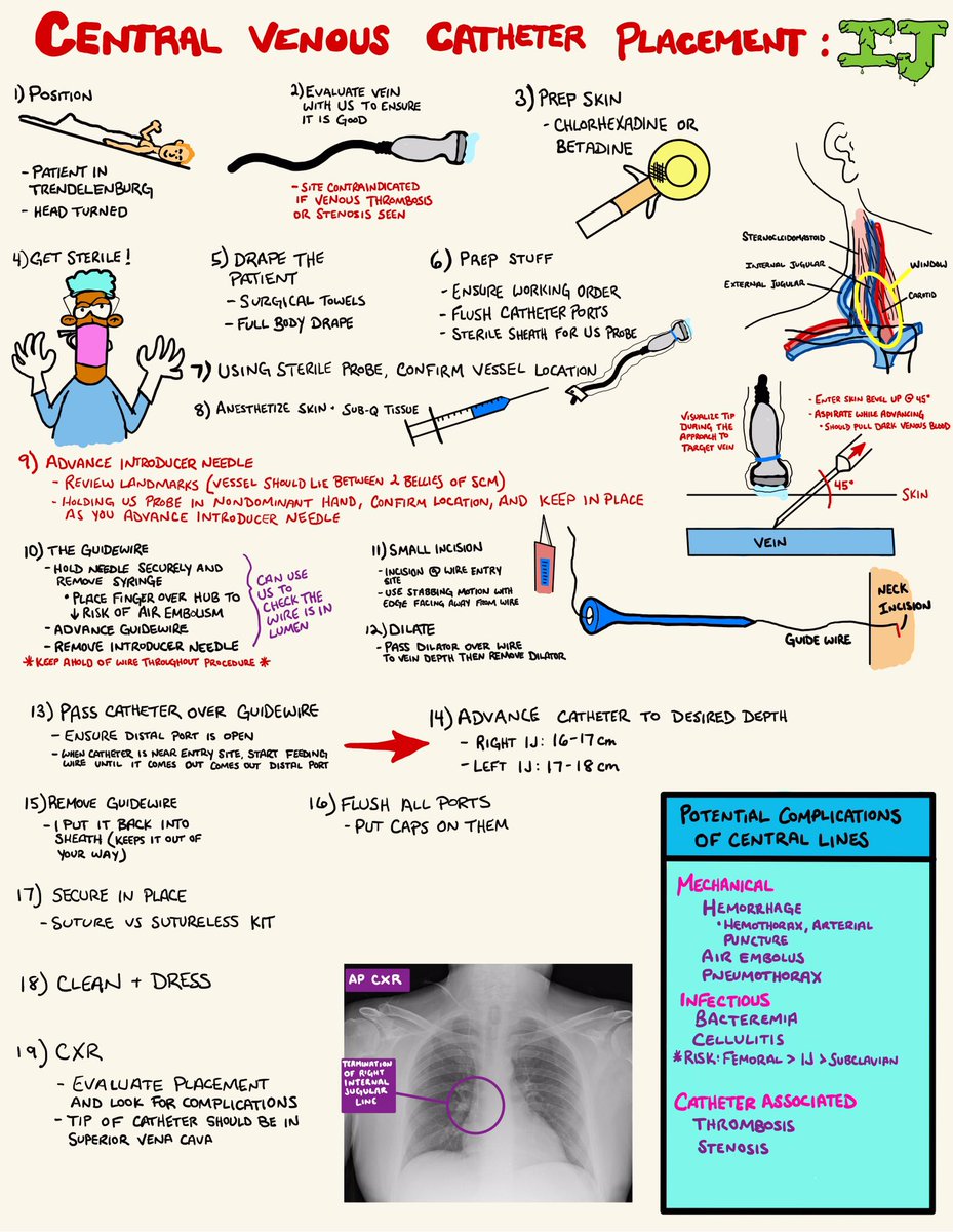 Venous Catheters Image at Ethan Fuhrman blog