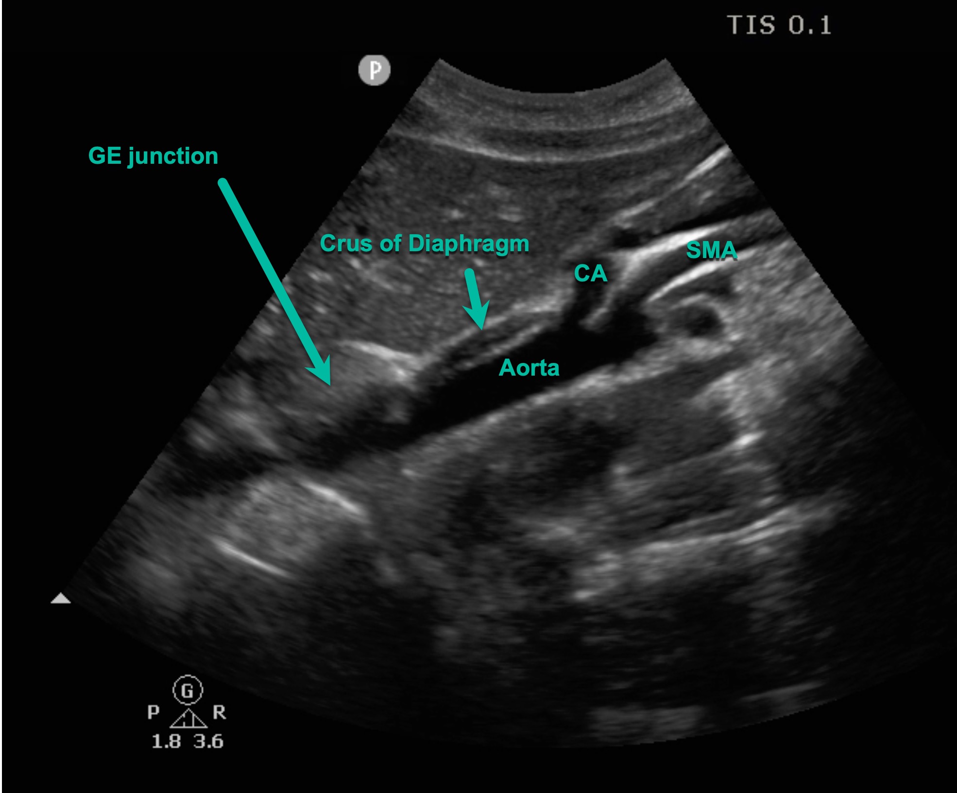 Gastroesophageal Junction Ultrasound