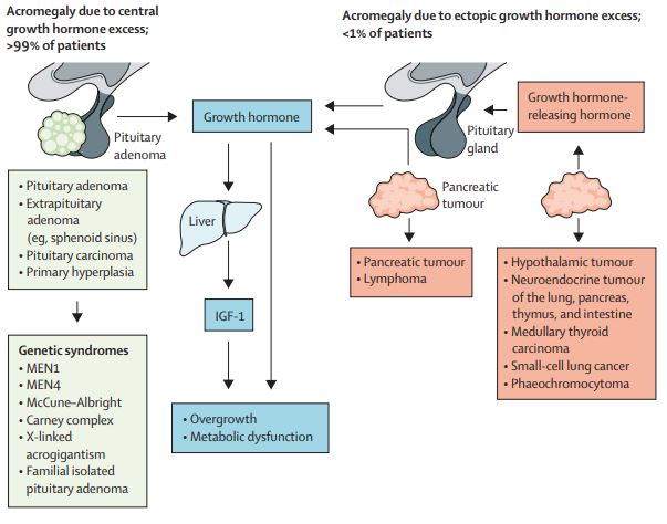 Acromegaly Diagram