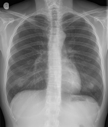 Routine chest X rays of young ladies. No symptoms. Dx ? - Thread from ...