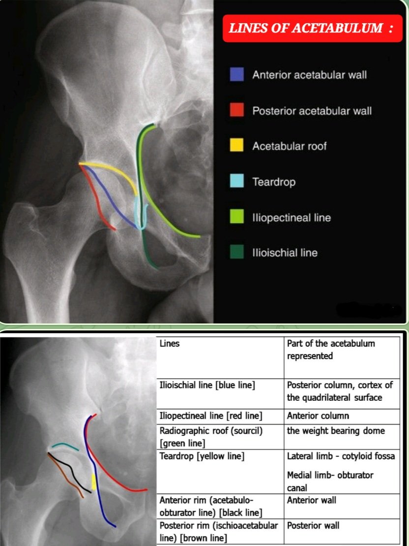 Acetabulum Anatomy