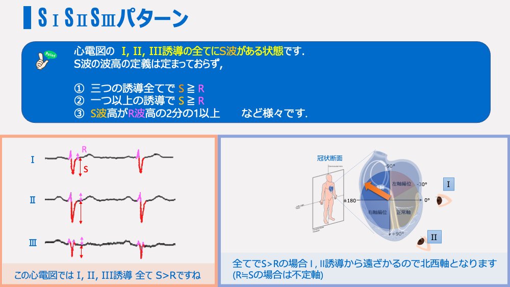 徳田道史 (とくだ みちふみ) @EP大学 アカデミック学部長 on Twitter: "心電図のS1 S2 S3パターン💞 たまに聞くことはありますが、 見つけたら何を考えるのか ...