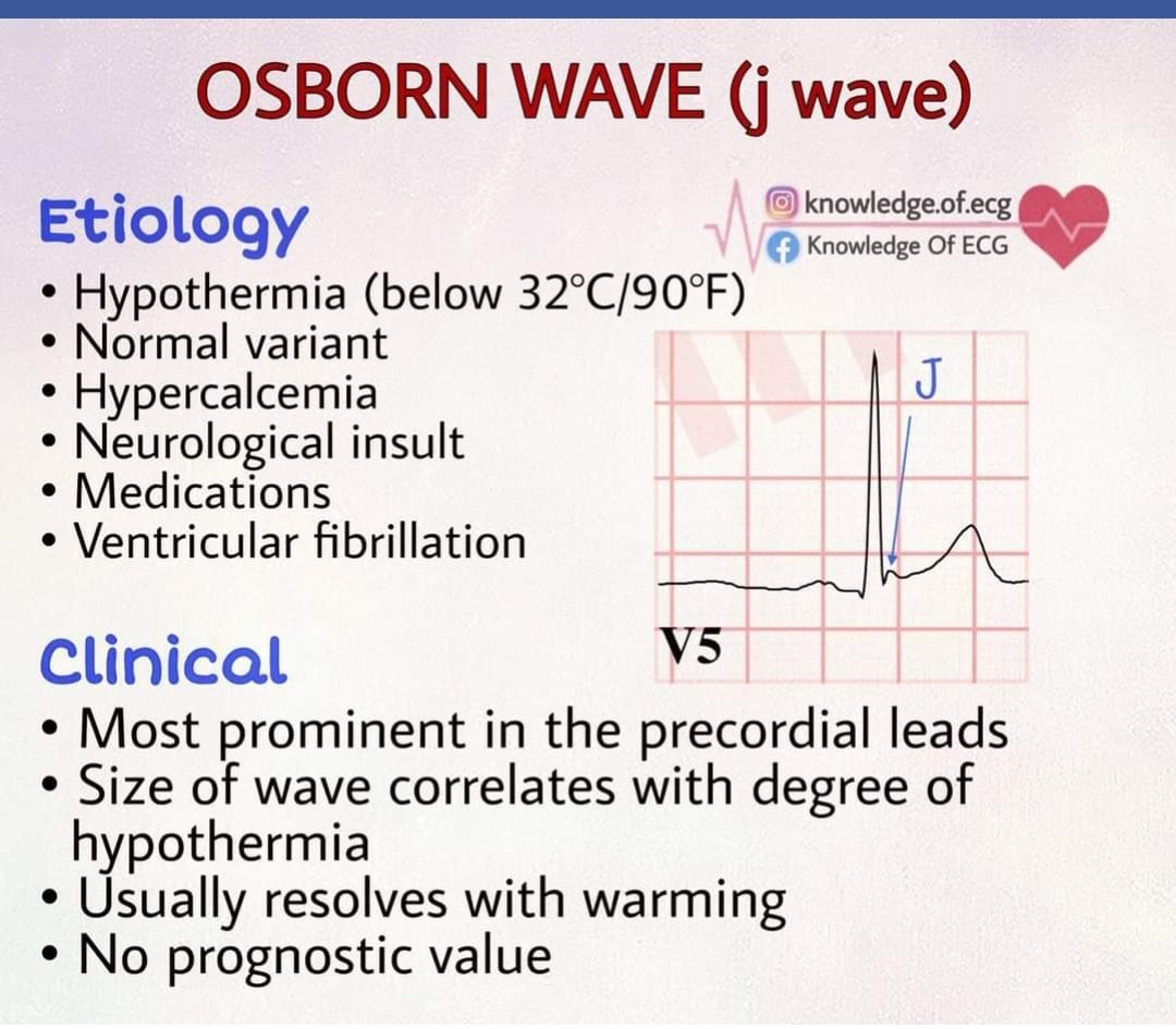 Sthanu on Twitter: "Osborn Waves deflection with a dome or hump configuration occurring at the R ...