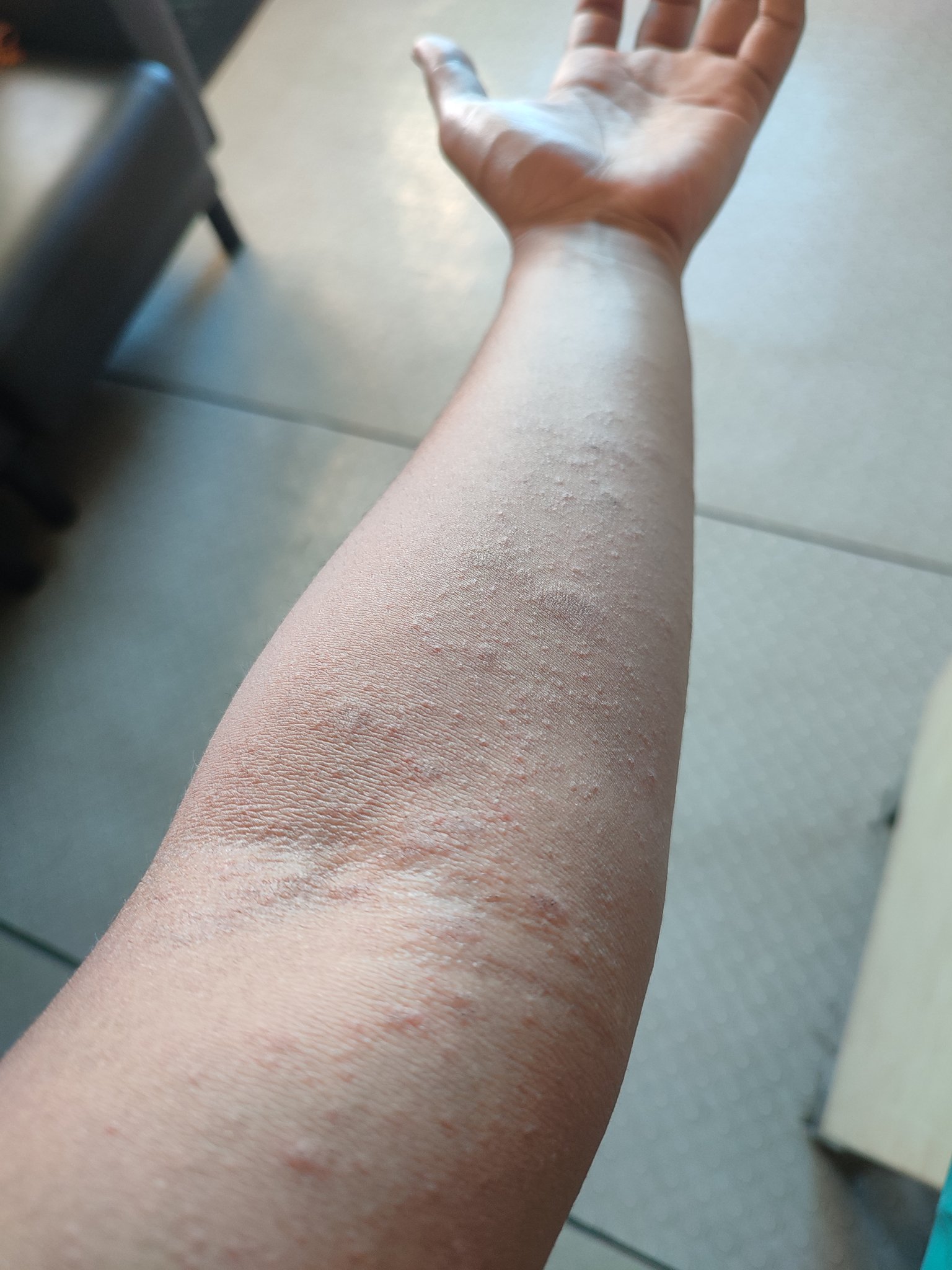 Rey.exp_ on Twitter: "Halo guys ada yang tau ga ini bentol bentol krn ...