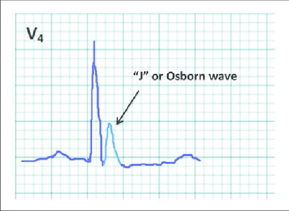 Osborn wave or J wave All is correct except? - المسلسل من Dr Ihab Suliman. دكتور ايهاب فتحي ...