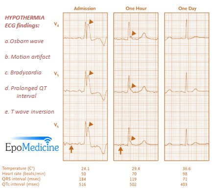 Osborn wave or J wave All is correct except? - Thread from Dr Ihab ...