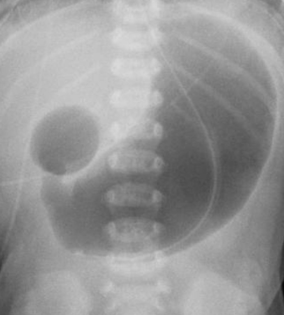 Radrounds Radiology Network On Twitter What Is The Double Bubble Sign