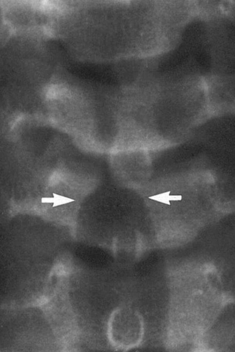 Radrounds Radiology Network On Twitter What Is The Steeple Sign