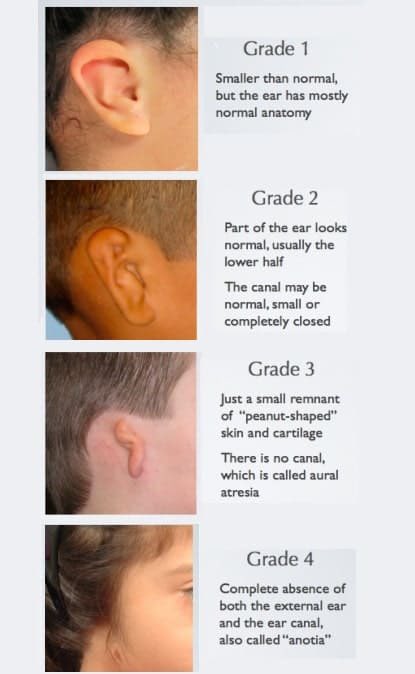 تختلف شدة تشوهات صيوان الاذن ، وغالباً ما يصاحبها تشوه لقناة الاذن ...