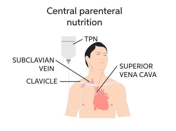 السلام عليكم ورحمة الله وبركاته هل سمعتم من قبل عن ال TPN أو التغذية ...