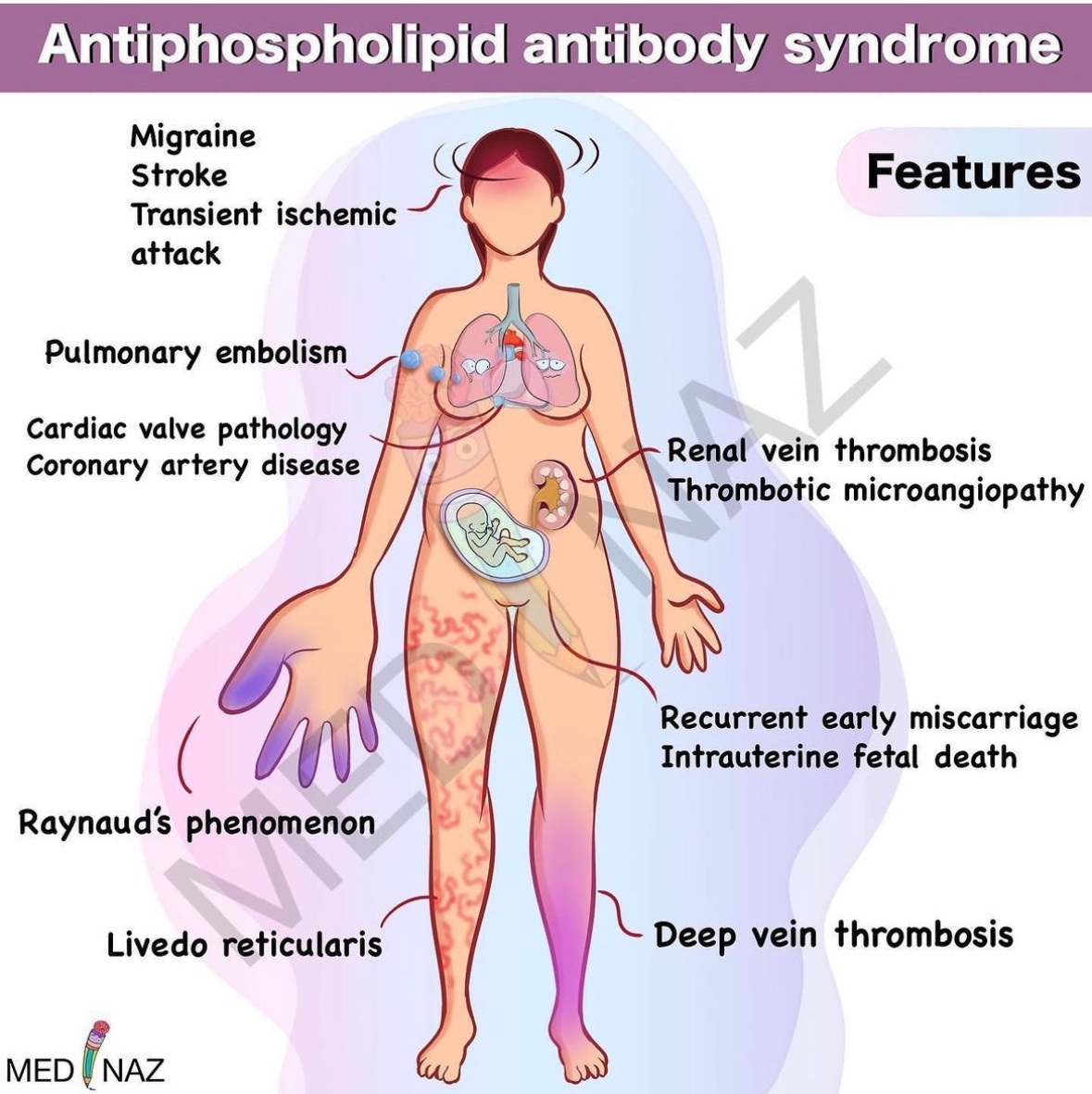 Brown Hospital Medicine On Twitter Antiphospholipid Antibody Syndrome