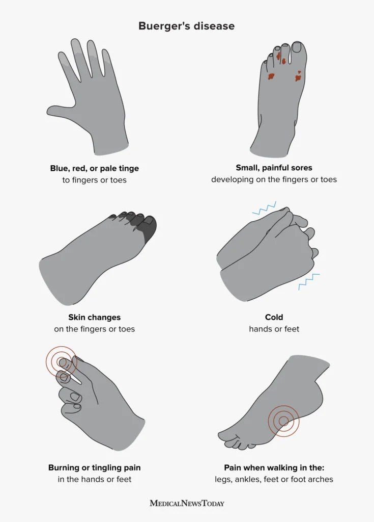 Thrombophlebitis In Fingers