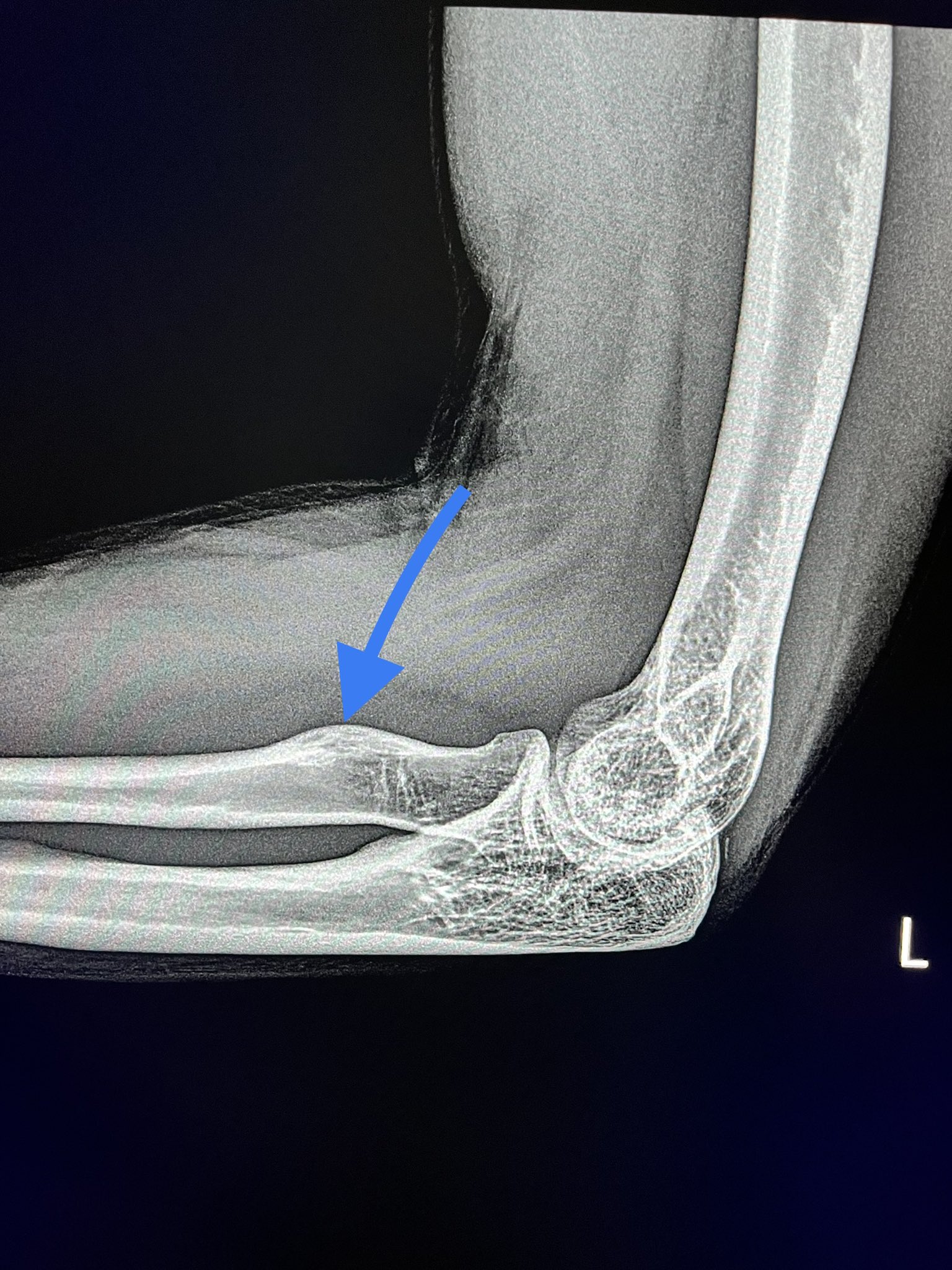 Radial Tuberosity Pseudonym Example Radial Tuberosity Anatomy In