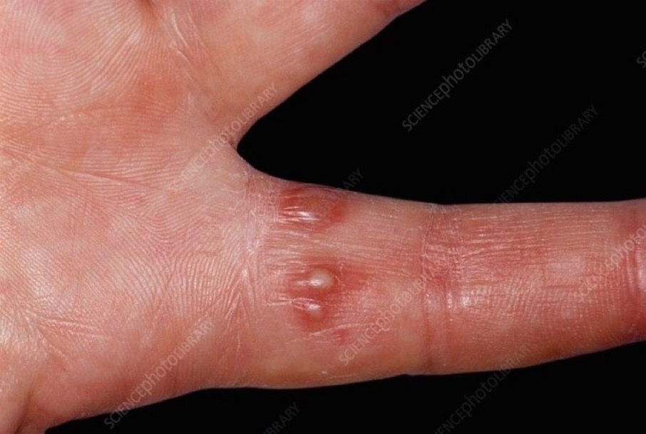Herpes On Hands
