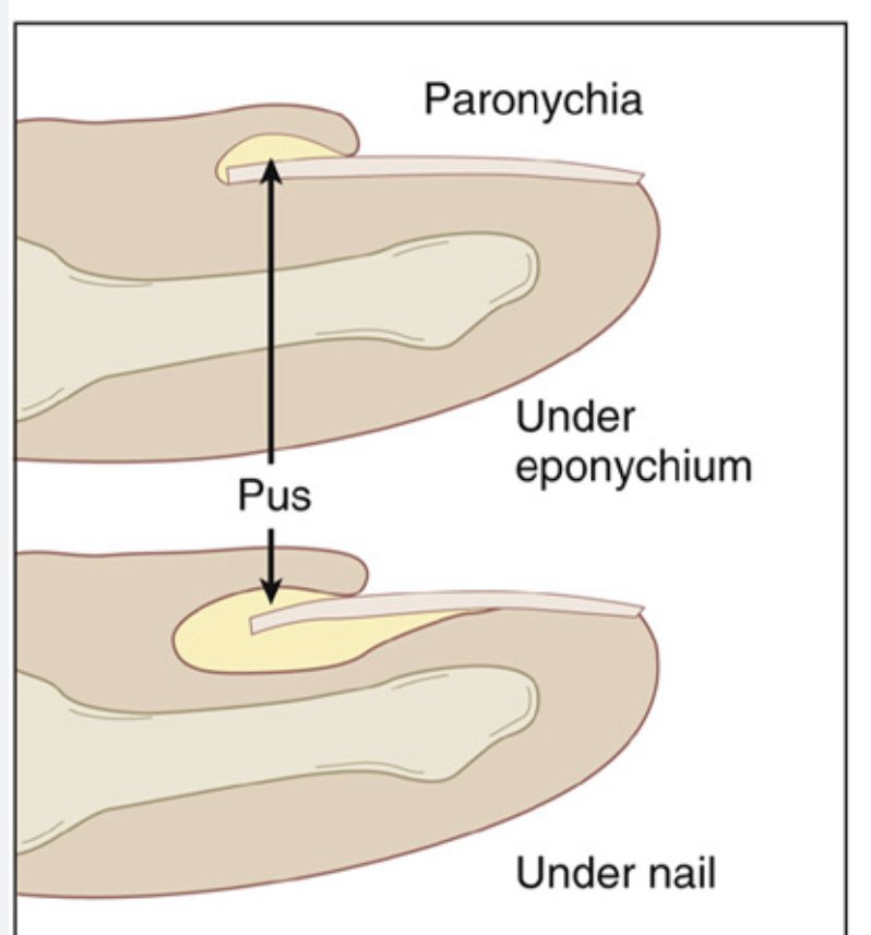Eponychium Infection