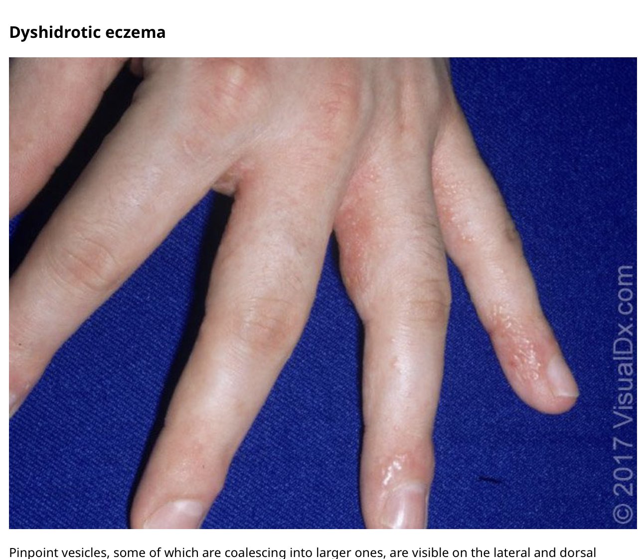 Herpetic Whitlow Hand