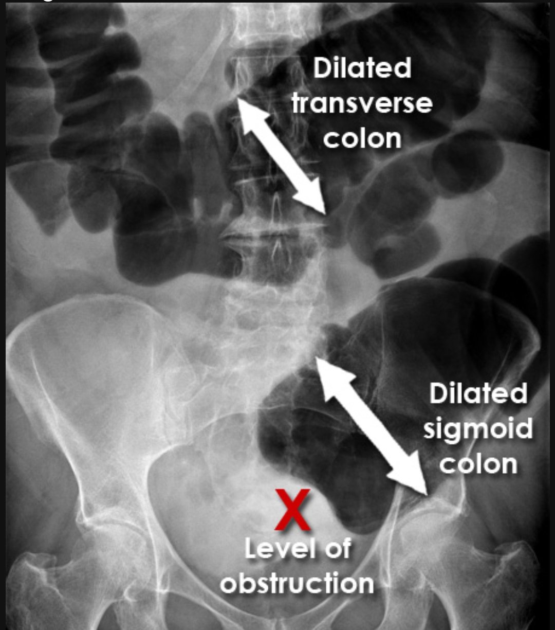 Causes Distended Colon
